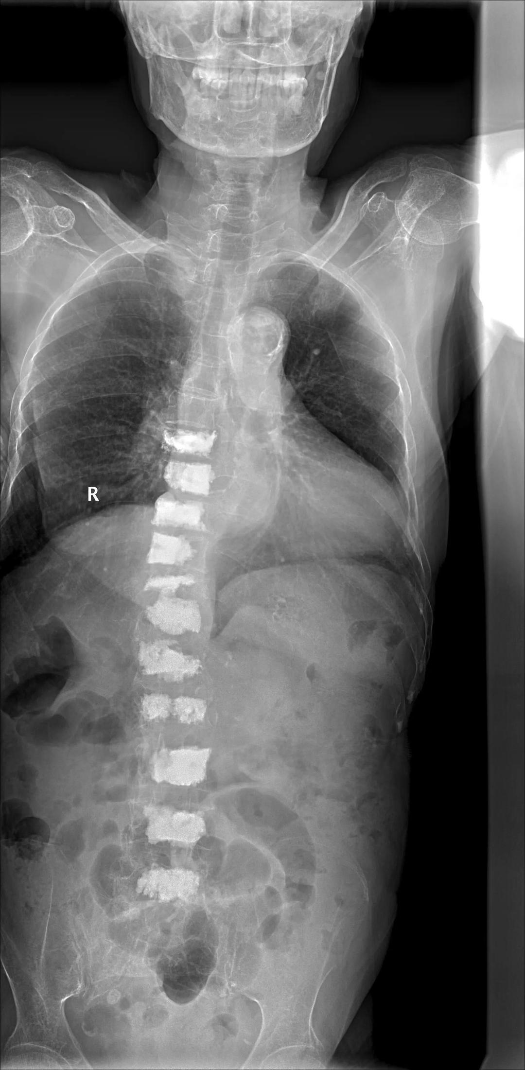11 fractures in the lower back, 8 surgeries, doctors said there was ...