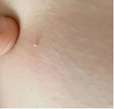 I have little fleshy bumps on my body, what are they? - iNEWS