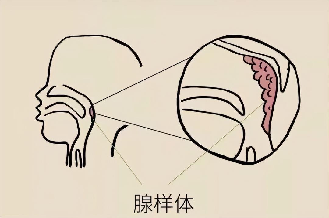 Traditional Chinese medicine has obvious effect in treating adenoid ...
