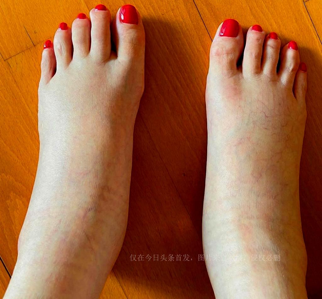 The 54-year-old Hong Kong actress's feet are as swollen as pig's ...