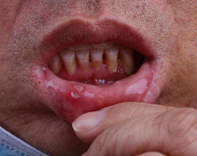 Lips are eroded, chapped, and can't be opened!Stay away from angular ...