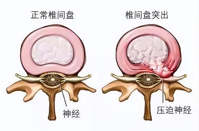 Long-term heaviness in your right leg may be because your disc is too ...
