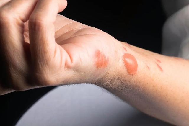 In severe cases, deep tissue necrosis may occur. Be careful when winter ...