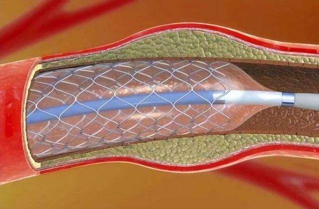 Is heart stent surgery a cure or a "harm"?How many years can I live ...