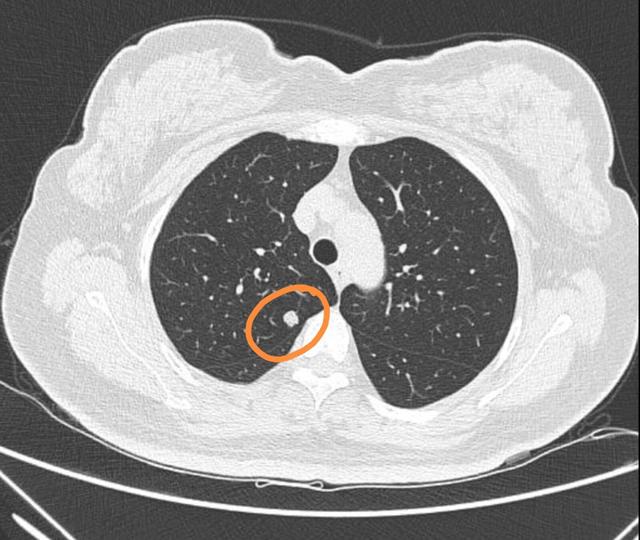 Dr. Liu Yi said that a one-centimeter lung nodule found in the physical ...