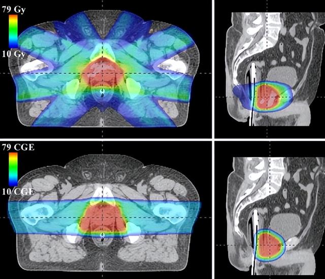 Japan's hypofractionated proton therapy for prostate cancer has the ...
