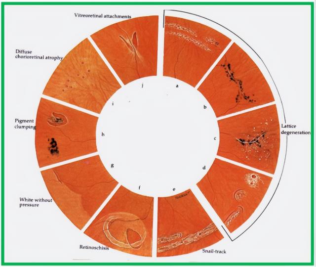 Professor Song Zongming talks about the grading and treatment of myopic ...