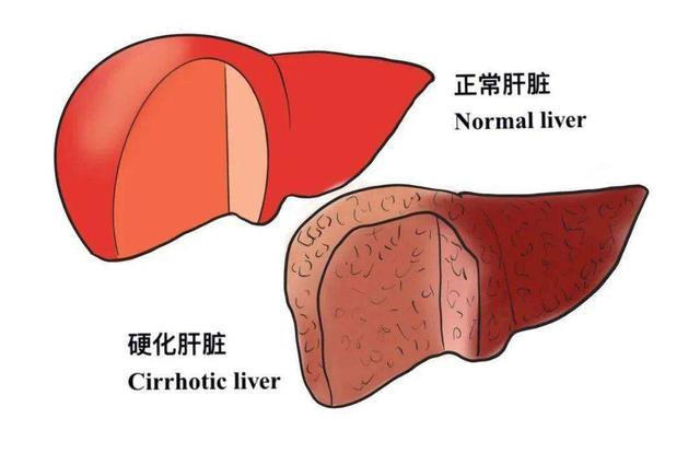 Typical clinical signs of liver cirrhosis—recognizing liver palms and ...
