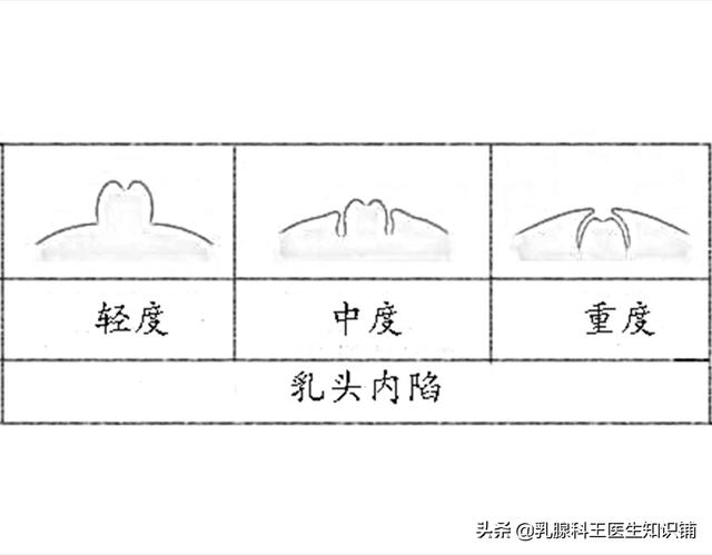 Inverted nipples appear like this and should be treated and prevented ...