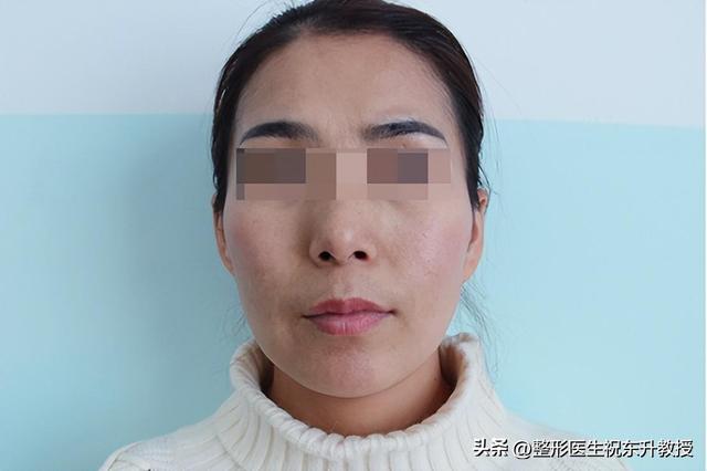 A full face makes you look younger!15-day real record of autologous fat ...