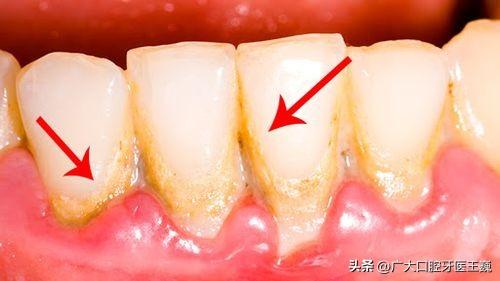 The culprit that made your teeth rot quietly has been found!It's the ...
