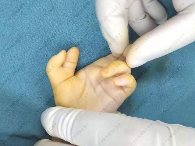 How long does it take to recover after the child has an extra finger ...