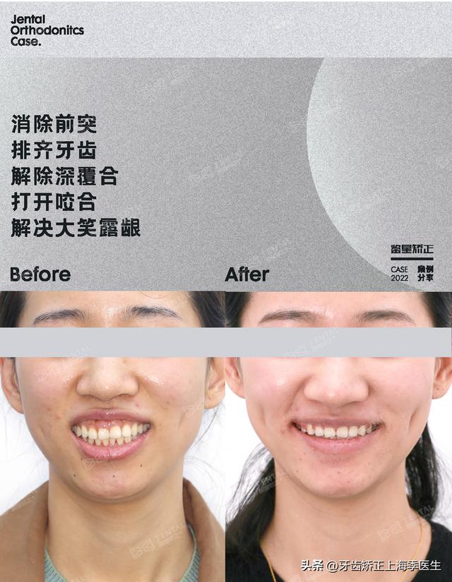 Bone buck teeth, open lips, chin retraction... Can adults correct their ...