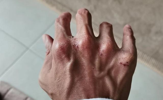 41-year-old Nicholas Tse was injured while filming!The knuckles are ...