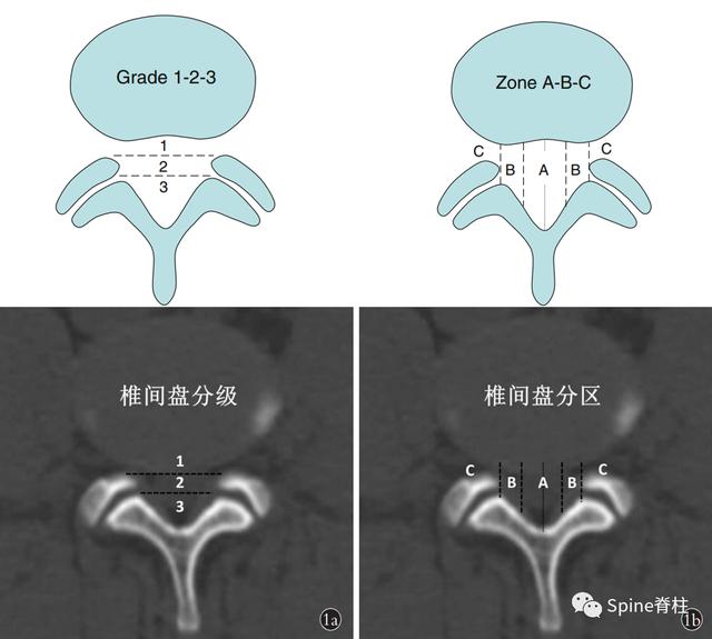 MSU grading and division of lumbar disc herniation (commonly used ...
