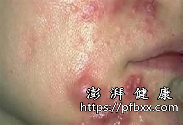 Acne has hard bumps on the face, the skin is red, swollen and painful ...