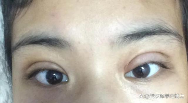 Why is your double eyelid "fake one eye"?Let a professional doctor ...
