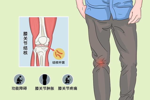 How much do you know about joint tuberculosis, which is more difficult than spinal tuberculosis ...