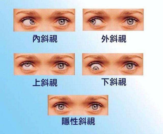 Long-term non-wearing of corrective glasses may be an important reason ...