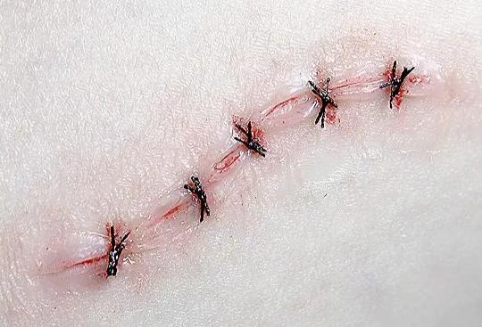 How to remove scars after stitches?How to repair stitch scars - iNEWS