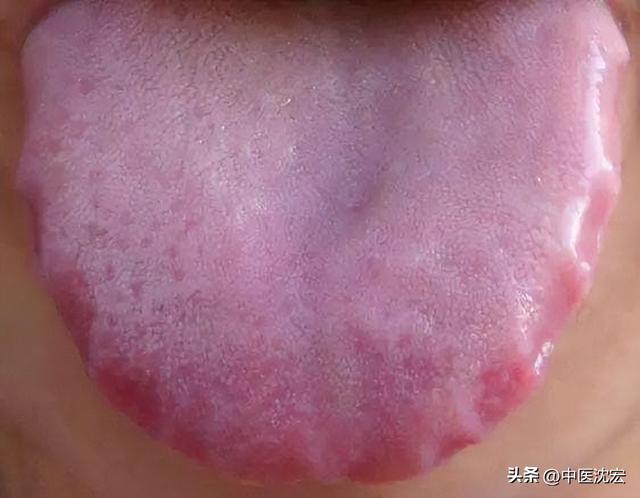 Teeth-marked tongue and thick tongue coating are the root of all ...