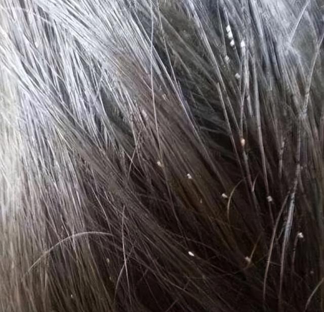 How did people get lice in the 1970s and 1980s, and how can we prevent ...