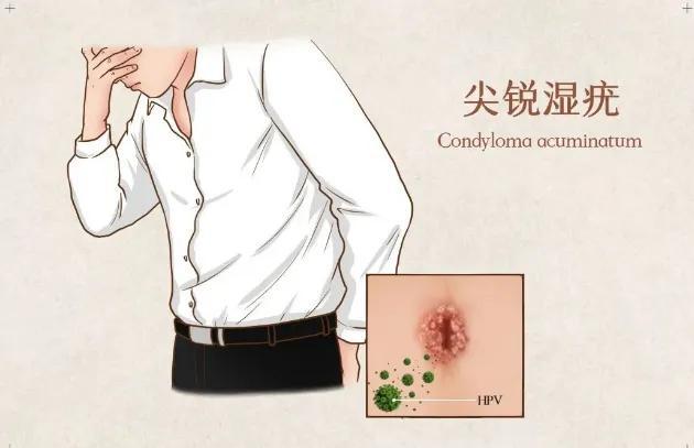 How long can the HPV virus of condyloma acuminatum survive outside the ...