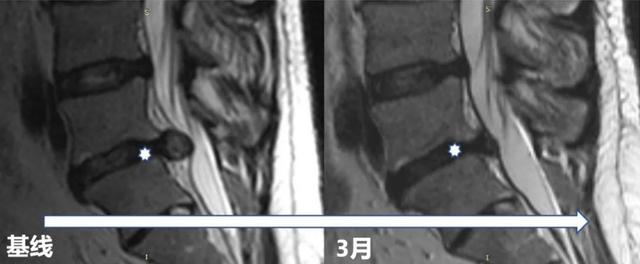 Predictors of early reabsorption in lumbar disc herniation - iNEWS