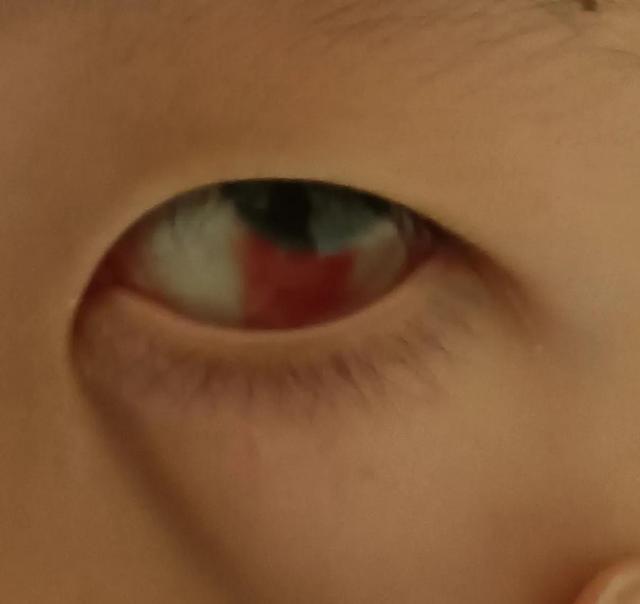 Subconjunctival hemorrhage is not so scary - iNEWS