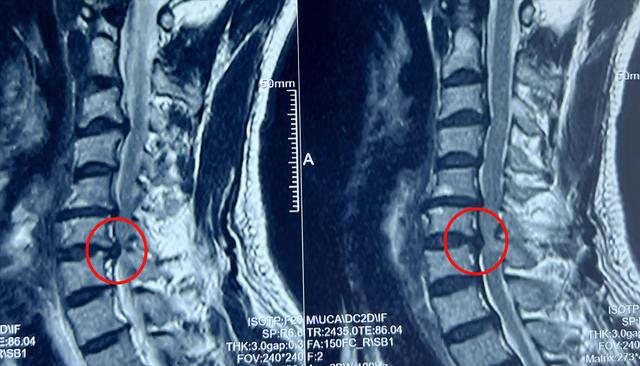 Walking unsteadily mistaken for a herniated lumbar intervertebral disc ...