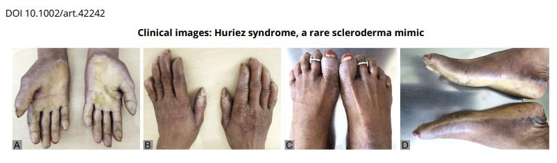 Huriez syndrome, a rare mimic of scleroderma! - iNEWS
