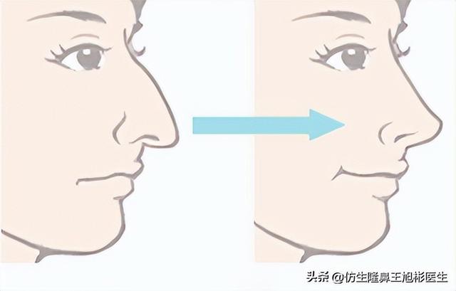 "Hook nose" is fierce and old, how to correct it? - iNEWS