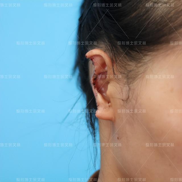 A piece of my ear was bitten off, how to fix it? - iNEWS