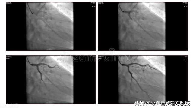 Is coronary angiography surgery?Does the operation hurt?What should I ...