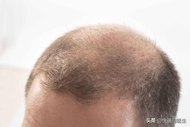 Washing hair with water to cure baldness?If you want to prevent ...