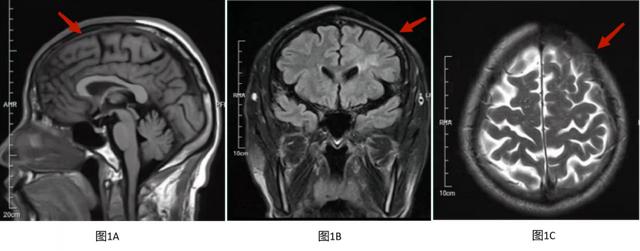 Scalp "knife cut" sign?There is another "hidden feeling" in the skull ...