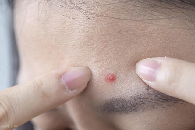 Tophi actually squeezed by hand?the risk is too great for you to bear ...