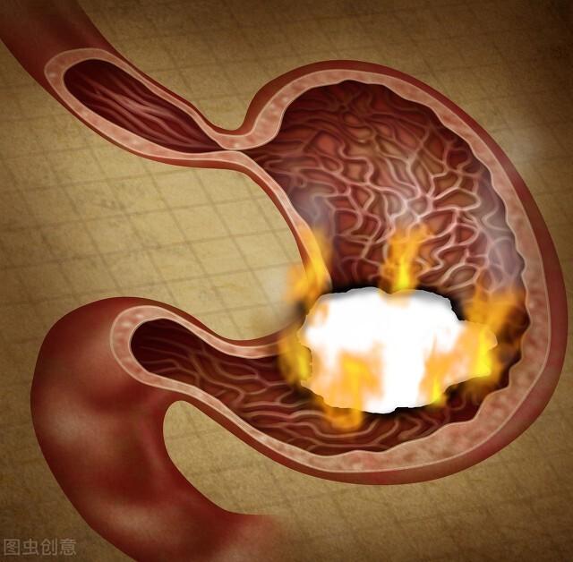 "Case Story" The real cause of a 20-year-old unhealed stomach ulcer was ...