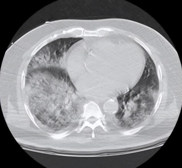 How to treat "white lung"?Chinese medicine share a prescription - iNEWS