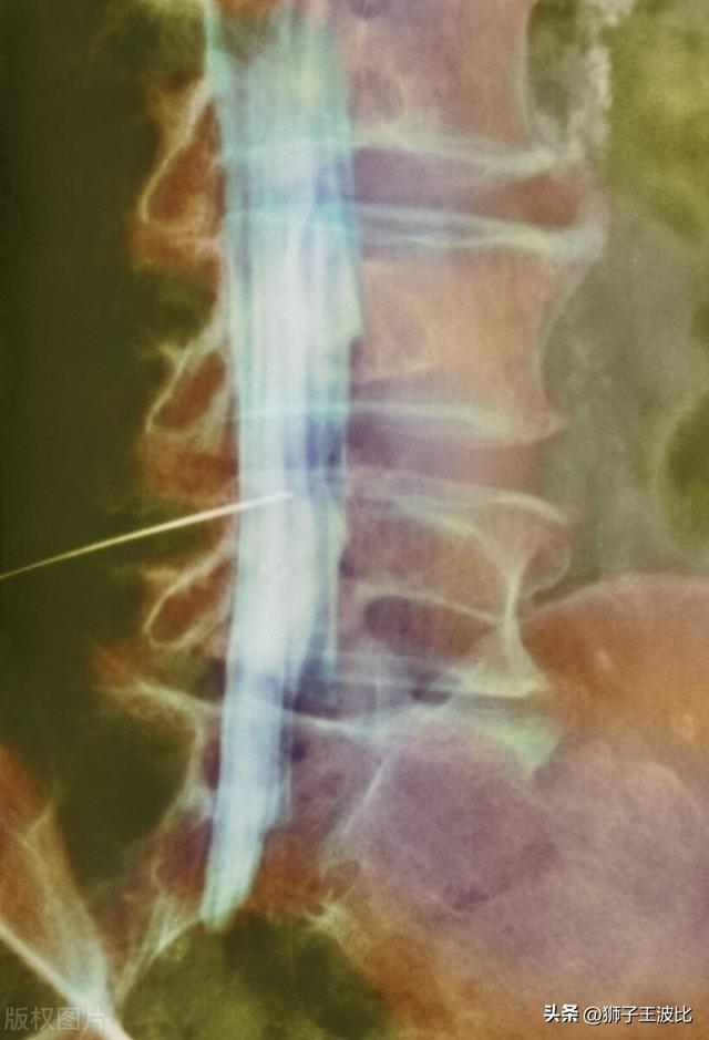 Lumbar muscle strain?Lumbar disc?Stupid can't tell?Lumbar disc ...