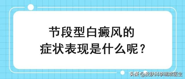 What are the symptoms of segmental vitiligo? - iNEWS