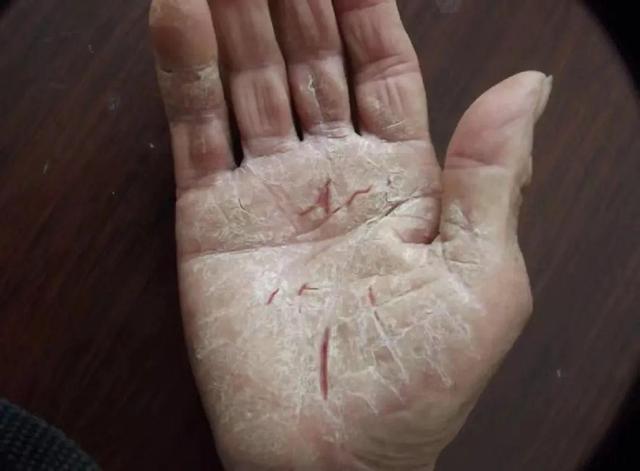A hand full of cracks?If you want to get rid of chapped hands and feet ...