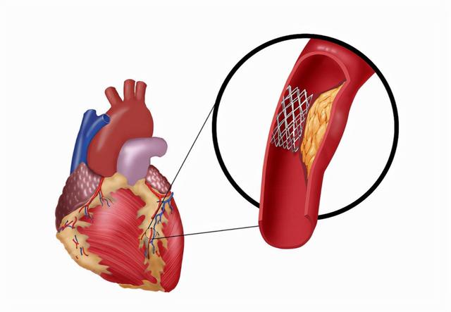 How long can you live with a heart stent?The doctor tells the truth ...