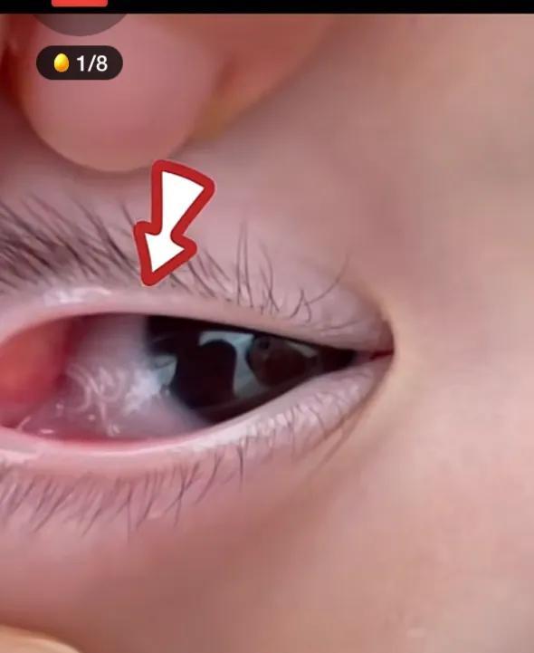 Eight parasites appear in boy's eyes, doctors have removed them - iNEWS