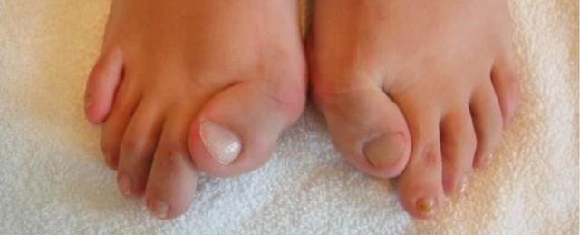 Researchers track an ultra-rare disease that turns muscle into bone - iNEWS