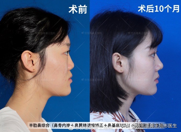 "Doctor, can the sunken face be improved without nasal base filling ...