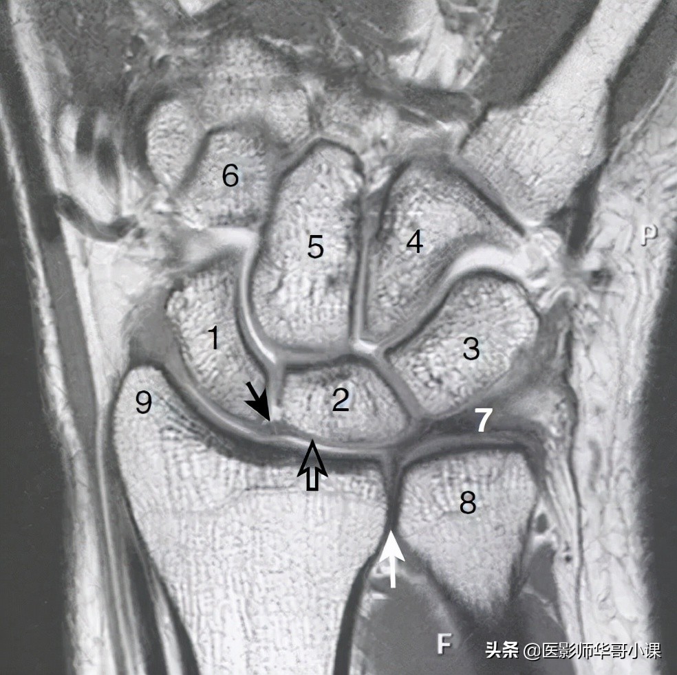 "Share" anatomy: imaging features of the forearm, wrist and hand - iNEWS