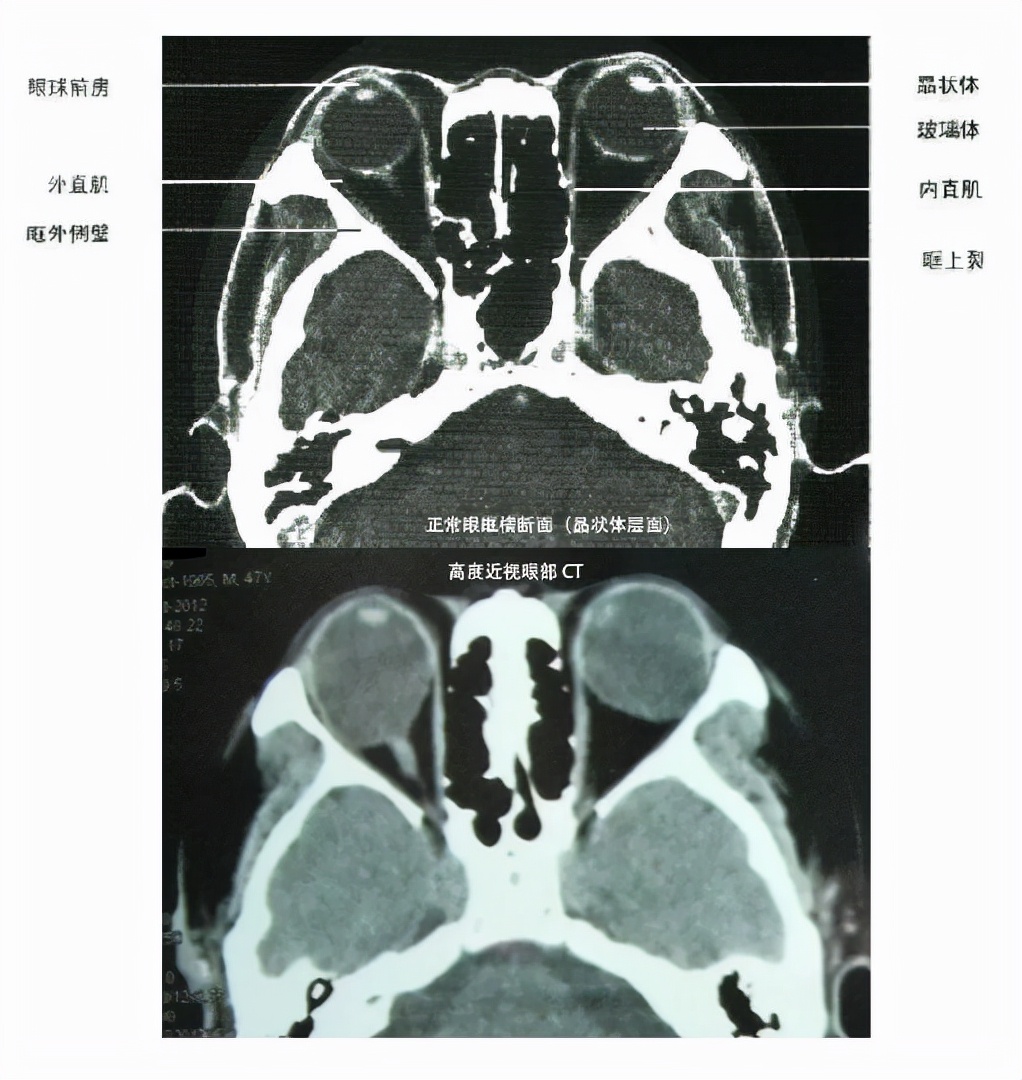 "Poster scleral reinforcement" gospel for patients with high myopia - iNEWS
