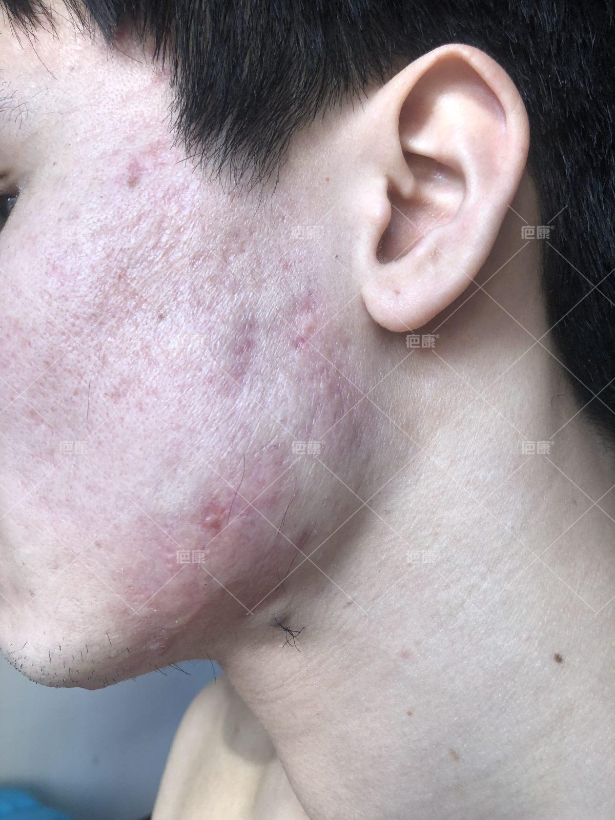 (Scar Kang) If your acne doesn't go down for a long time - iNEWS