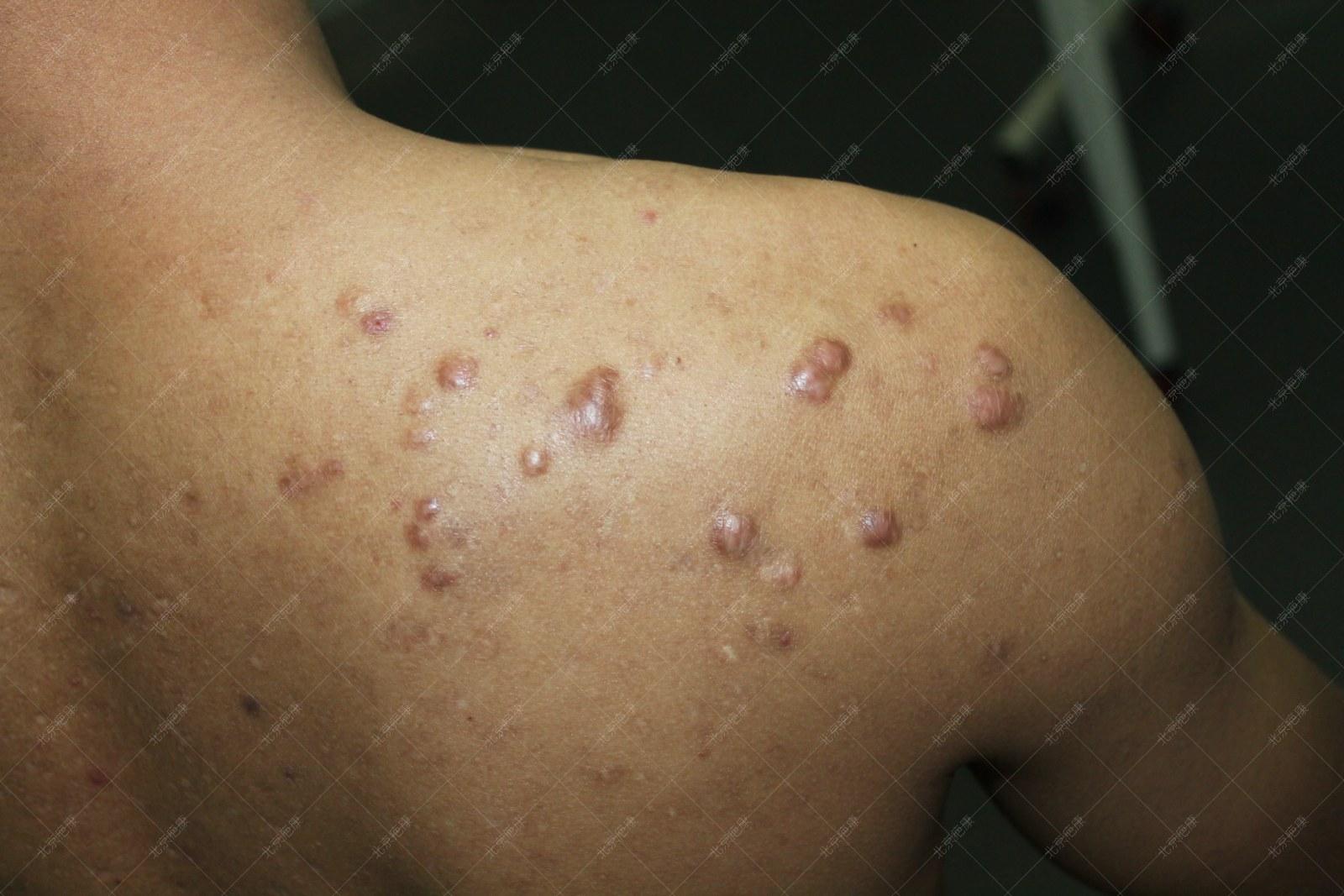 (Scar Kang) Red and swollen bumps on the shoulders - iNEWS